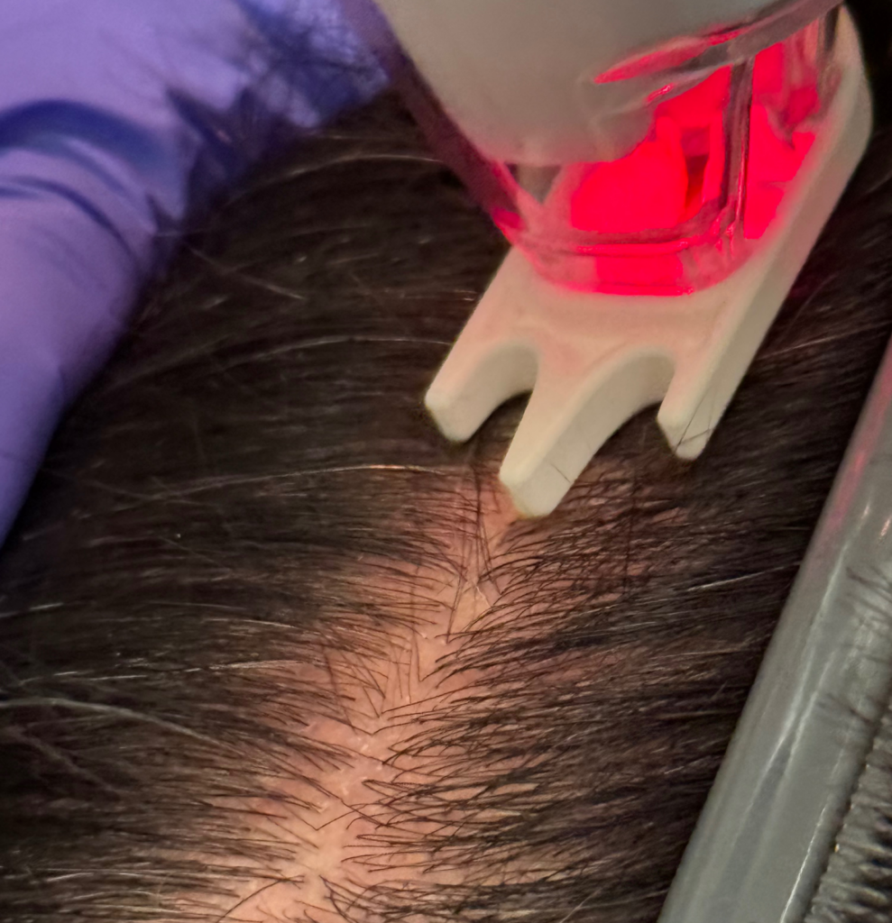 Keralase™: The Ultimate Solution for Hair Growth - Refresh Med Spa LA