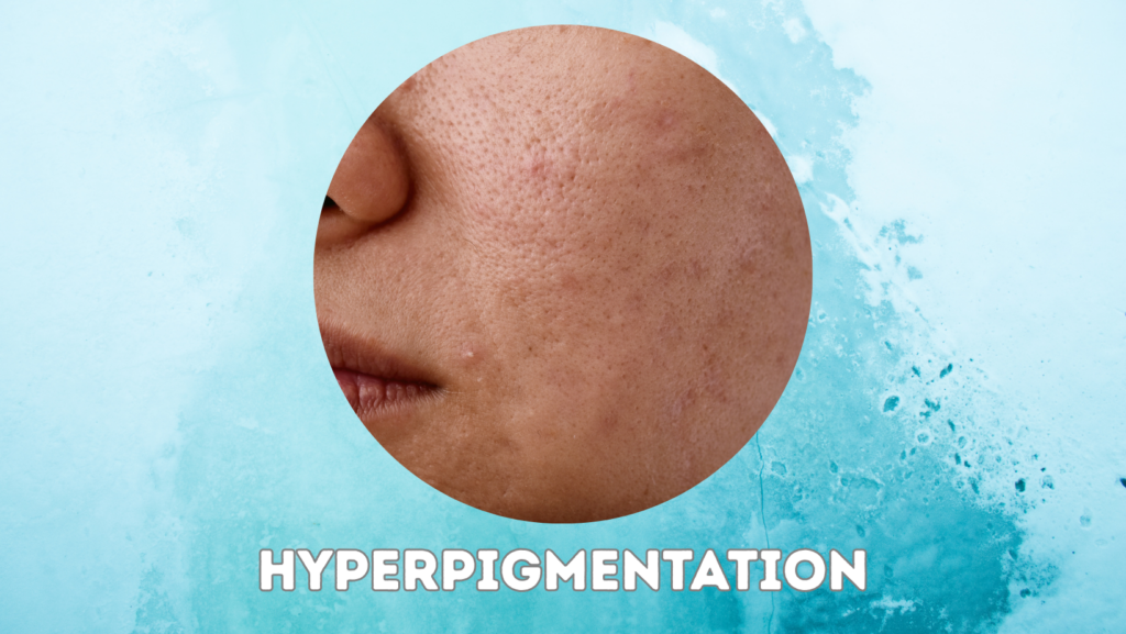 Your Guide to Skin Hyperpigmentation Treatments - Refresh Med Spa LA